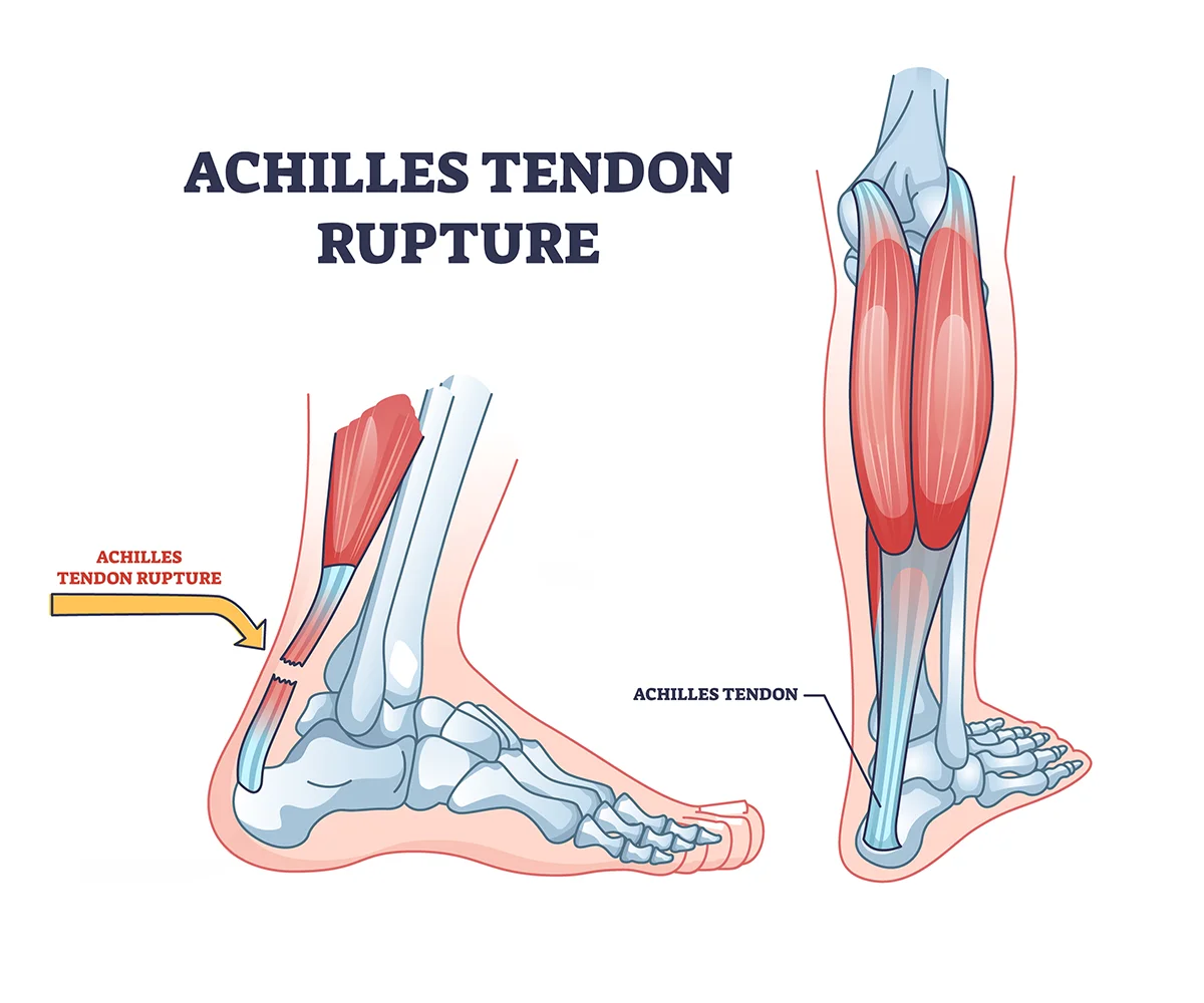 Achilles Tendon Rupture Achilles Tendon Tear Or Rupture Ankle Achilles Tendon Rupture Achilles Tendon Tear Or Rupture Ankle