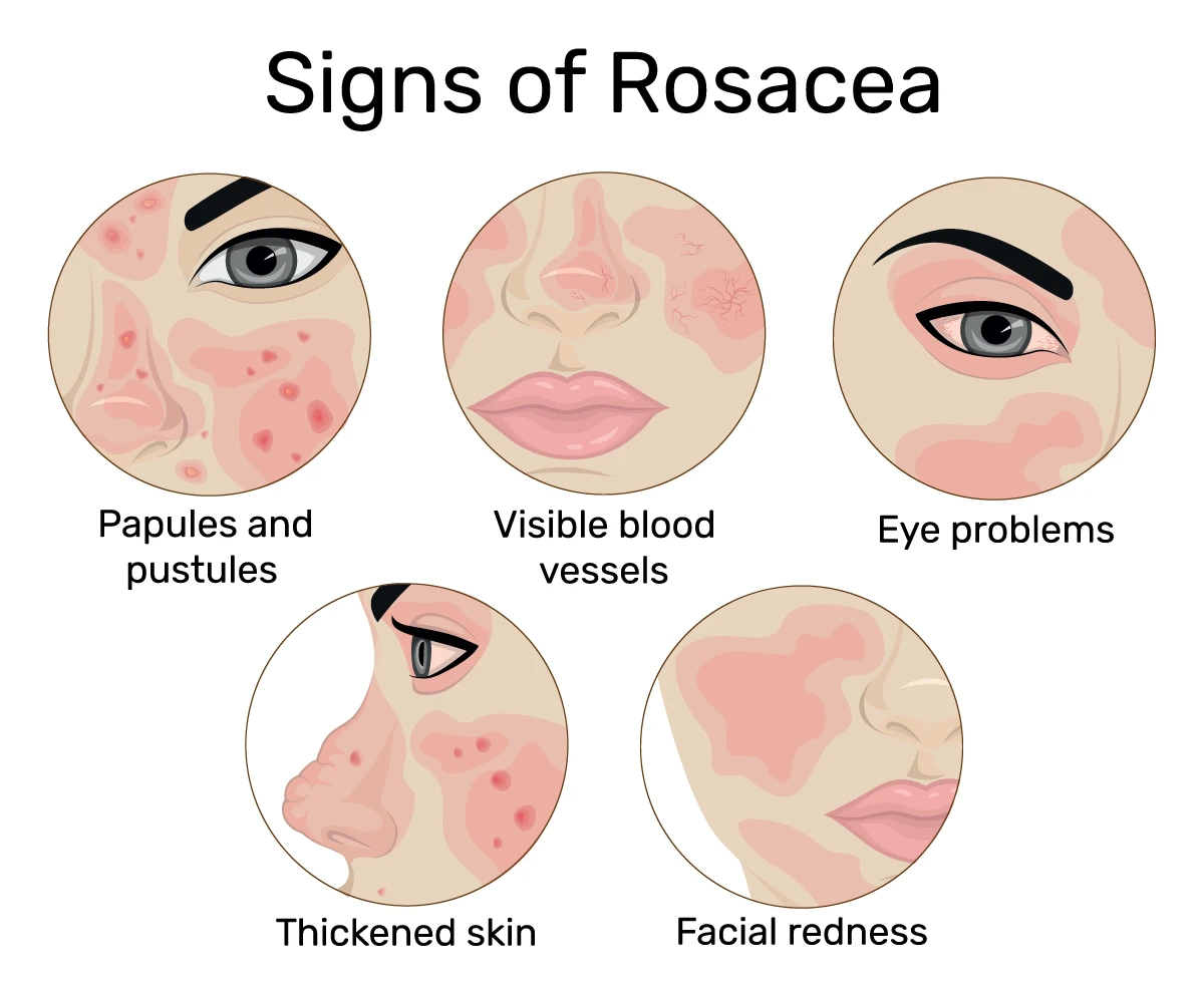 Rosacea Symptoms Treatment Aurora Health Care Rosacea Symptoms Treatment Aurora Health Care
